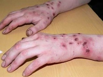 Detectan primer adicto a 'Krokodil' en México | El_weso | Audio | W ...